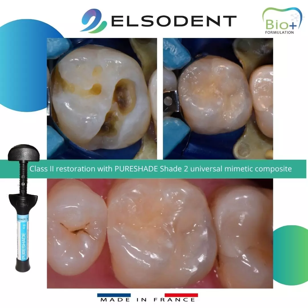 🦷 Why Choose a Universal Mimetic Dental Composite? - Elsodent